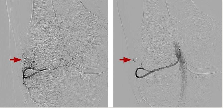 Geniculate Artery Embolization Gae Imagecare Centers