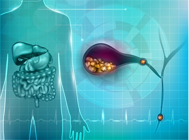 Biliary Stone Extraction | ImageCare Radiology