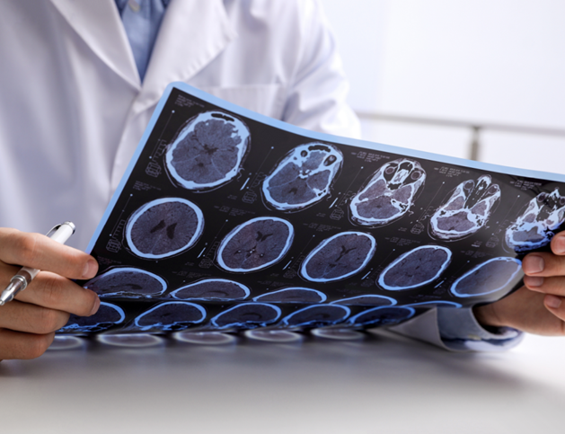 Diagnosing and Treating Brain Injuries from Auto Accidents with MRI